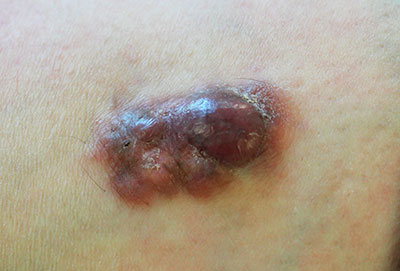 Sarcoma: Definición, tipos, síntomas y tratamiento